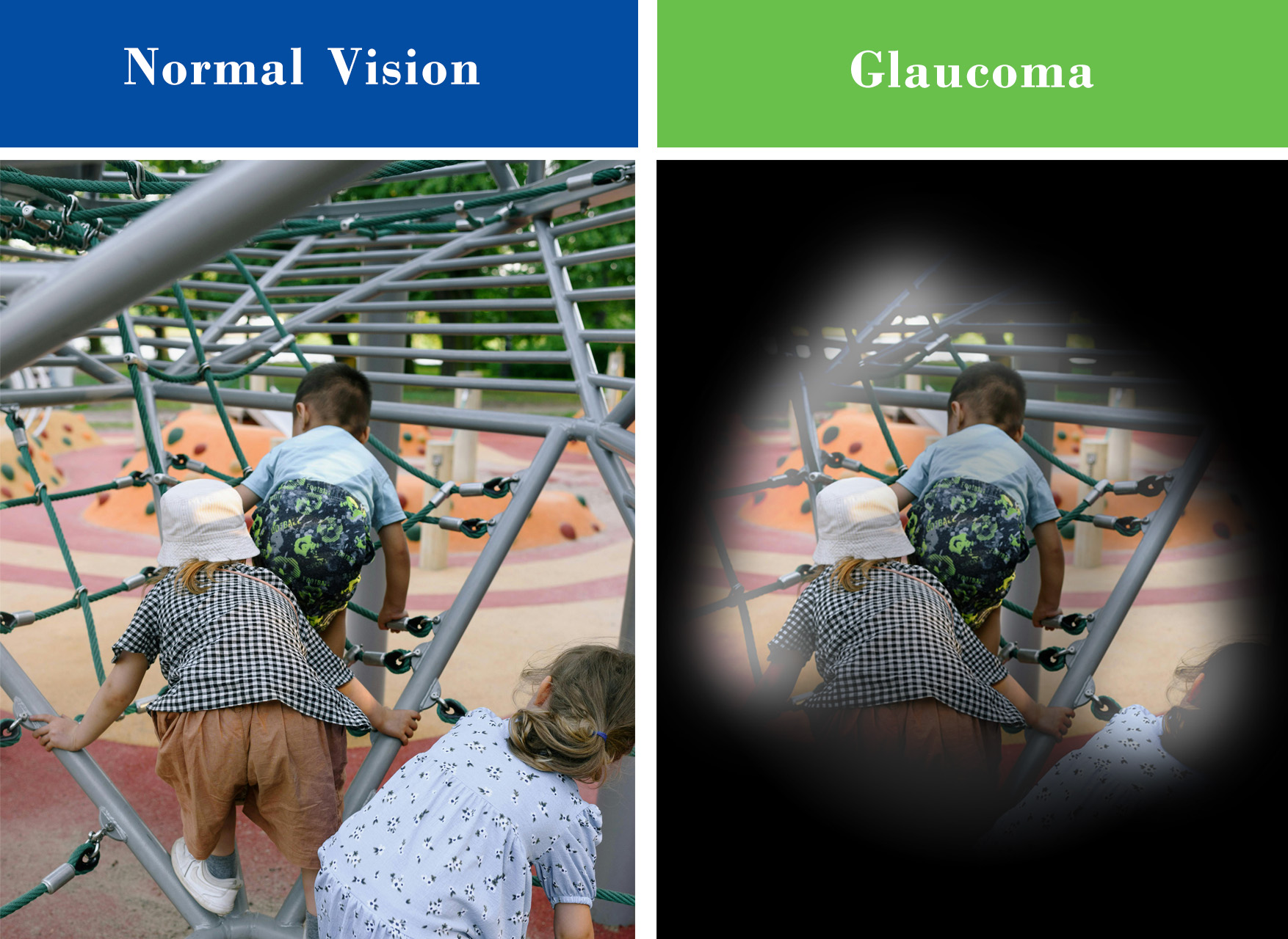 Glaucoma The Silent Thief Of Sight Thomas Eye Center